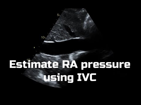 IVC for RA pressure - Echocardiography