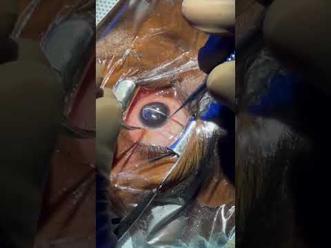 Smile Eye Surgery for -8 power patient!! #smile #eye #eyehospital #eyecare #eyesurgery #smilesurgery