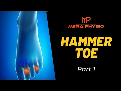 Hammer Toe - part 1 | Introduction | In Hindi | Mera Physio