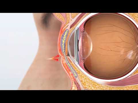 Sage Eyecare offers LipiFlow Thermal Pulsation System