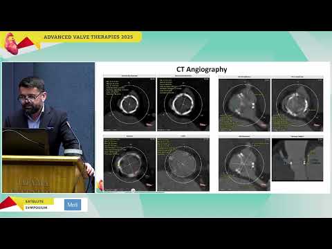 I. Kosmas, I. Iakovou | Case LIVE-in-a BOX: ViV case with Coronary Protection | Onassis Hospital