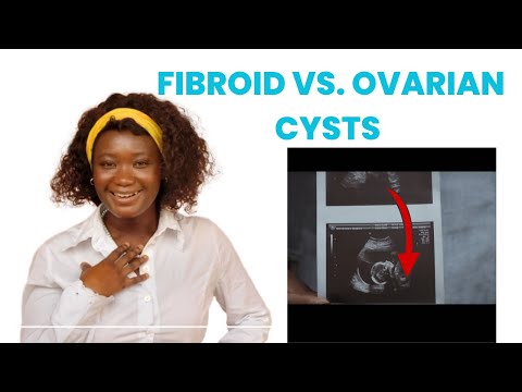 Fibroids vs. Ovarian Cysts: Key Differences, Symptoms & Treatment Options You Should Know!