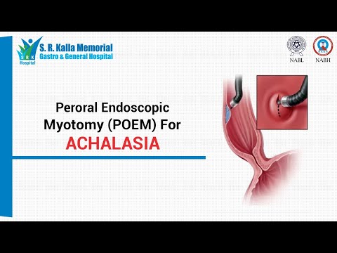 Peroral Endoscopic Myotomy (POEM) for Achalasia