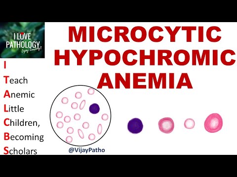 MICROCYTIC HYPOCHROMIC ANEMIA. Causes, Mechanism & Approach