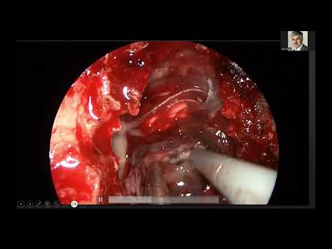 Posterior Fossa Lesions – Professor Ramesh Nair