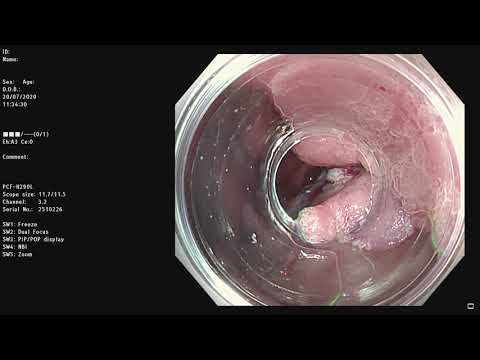 D3 large polyp EMR with ORISE gel and Captivator II