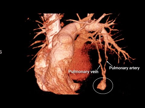 Case 64: Pulmonary arteriovenous malformation(PAVM)#radiology#ctscan #radiologist