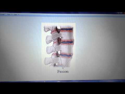 Spondylitis (Pott's Disease or Ankylosing Spondylitis)