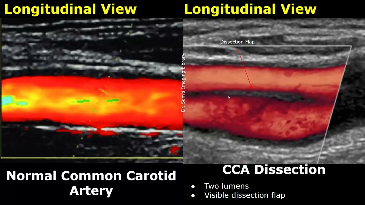 Carotid Artery Color/Spectral Doppler Ultrasound Normal Vs Abnormal Images | ICA Stenosis USG