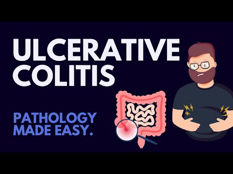 Ulcerative Colitis Pathology, Simply Explained!
