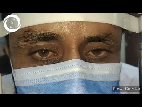 Abducens nerve palsy