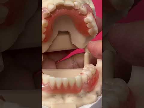 Unbreakable Flexi Partials!