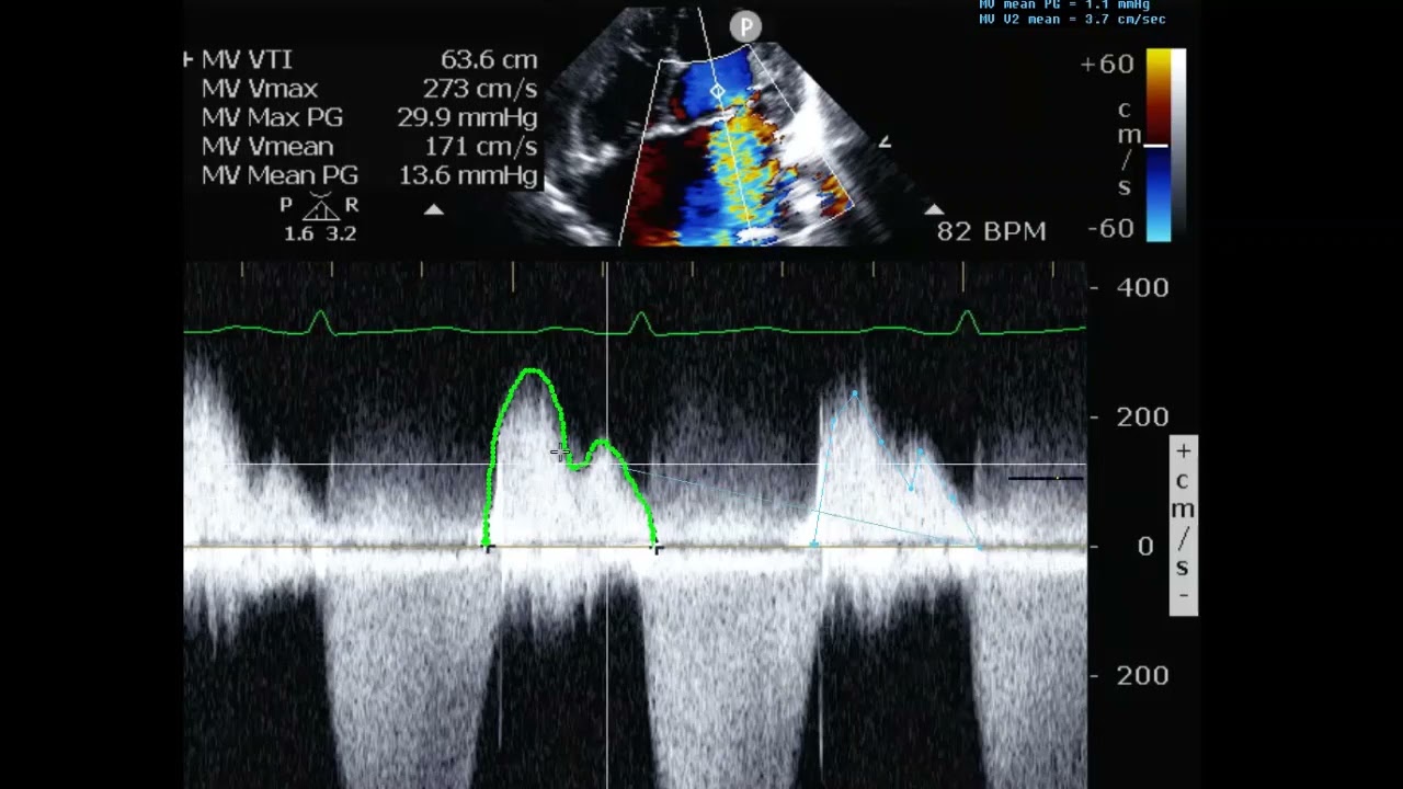Mitral Regurgitation and PISA calculation