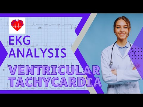 EKG Rhythm Analysis: Ventricular Tachycardia (VTach)
