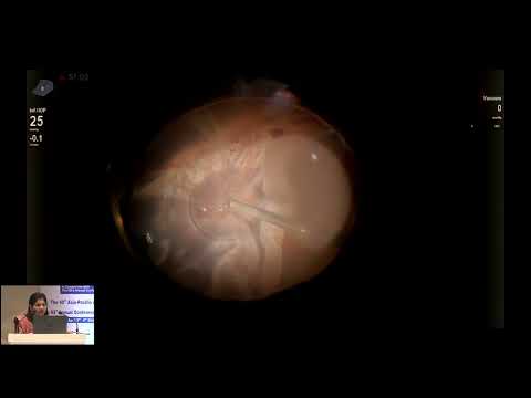AIOS2025 IC316 T Dr Shilpi NARNAWARE My Top Seven Pearls GRT