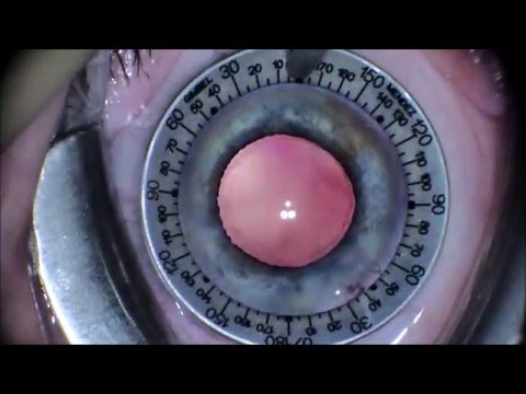 Using Toric Lens Implant Problems | Cataracts