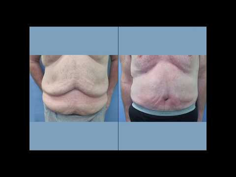 Dr. Joseph J. Castellano | Before & After Video: Liposuction Case #76
