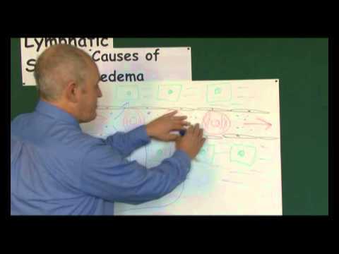 Causes of Edema (Oedema)