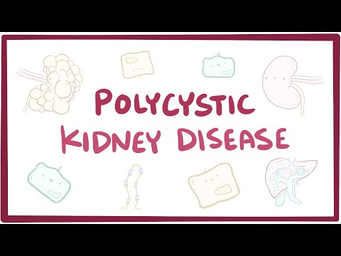 Penyakit ginjal polikistik - penyebab, gejala, diagnosis, pengobatan, patologi