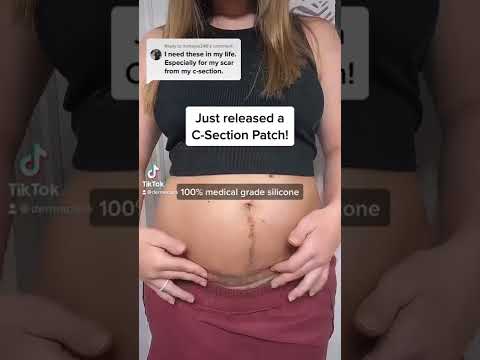 C-Section Patch to heal scars 🫶 #csection #scar