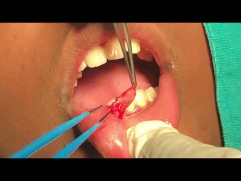 Mucous Cyst- lip