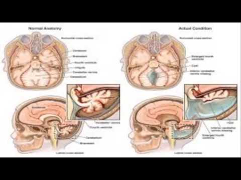 Dandy Walker Syndrome – Neuro1Hub