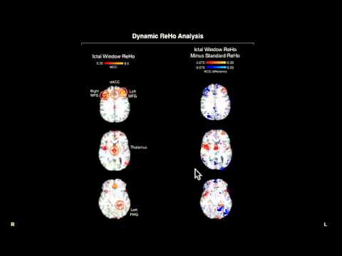 Dynamic changes in the peri-ictal period