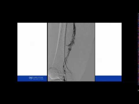 All About Deep Vein Thrombosis (DVT) and DVT Lysis treament