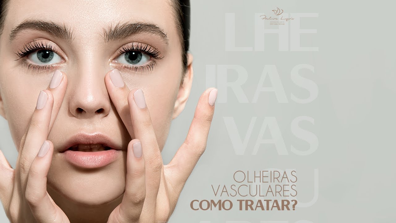Como tratar as olheiras vasculares. Dermatologista Pauline Lyrio. Vitória-ES