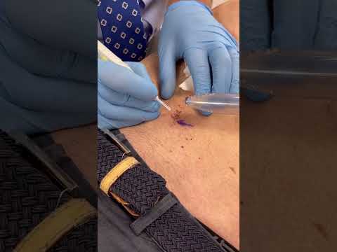 Large Mole Removed From Belly in 30 Seconds!