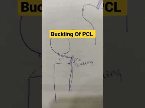 Buckling Of PCL ..Dr Sai Chandra.. Arthroscopy Surgeon In Hyderabad