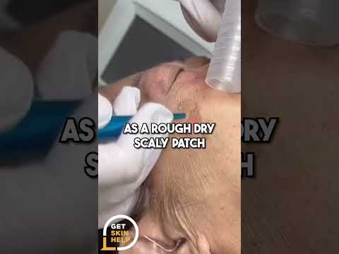 Actinic Keratosis #shorts #skincare