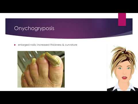 Pinpoint Uncommon Nail Disorders
