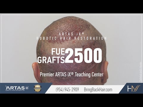 Hair By Dr. Max - 2500 FUE Grafts ARTAS® Robotic Hair Restoration