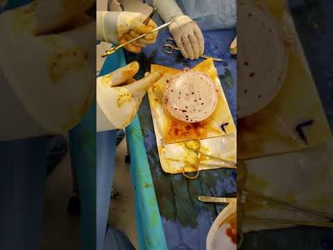 Wrapping a Mentor(r) expander with Cortiva(TM) 16x20cm ADM