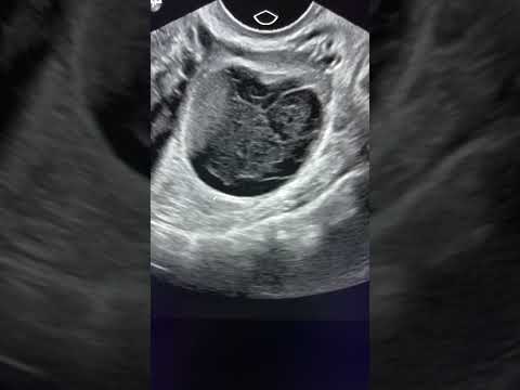 Hemorrhagic ovarian cyst - USG