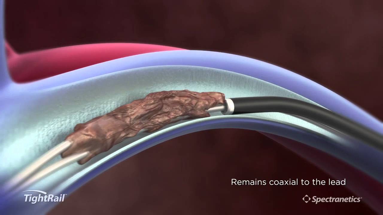 TightRail animation