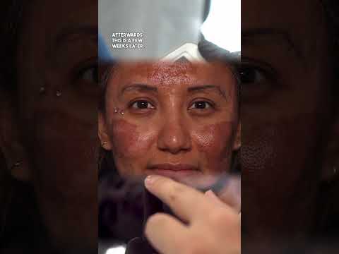 This Acne Scar Treatment Was LIFE CHANGING For This Patient #tcacross #subcision #co2laser