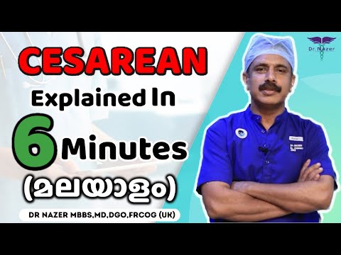 സിസേറിയൻ - സ്ത്രീകൾ അറിഞ്ഞിരിക്കേണ്ട കാര്യങ്ങൾ | MALAYALAM | Dr Nazer
