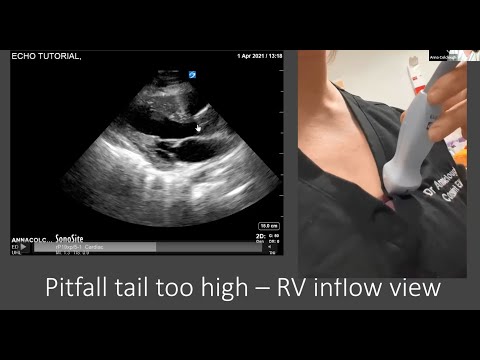 Basic ECHO in the unwell patient