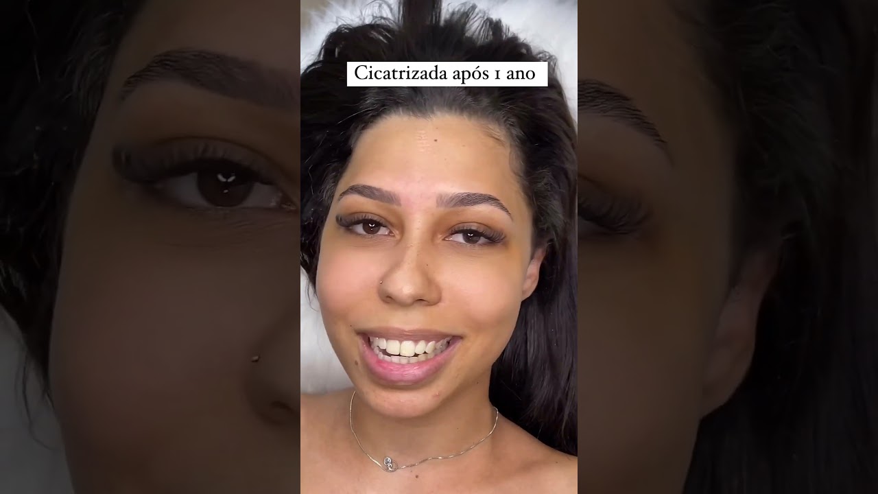 NANOFIOS NO DERMÓGRAFO  CICATRIZADA APÓS 1 ANO! #shorts