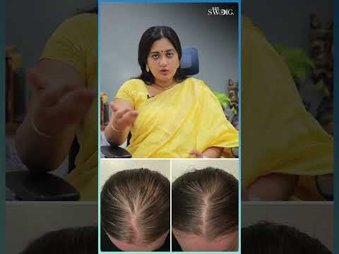 இது தெரியாம Minoxidil Use பண்ணாதீங்க! - Dr Shwetha Rahul Explains | Hair Fall