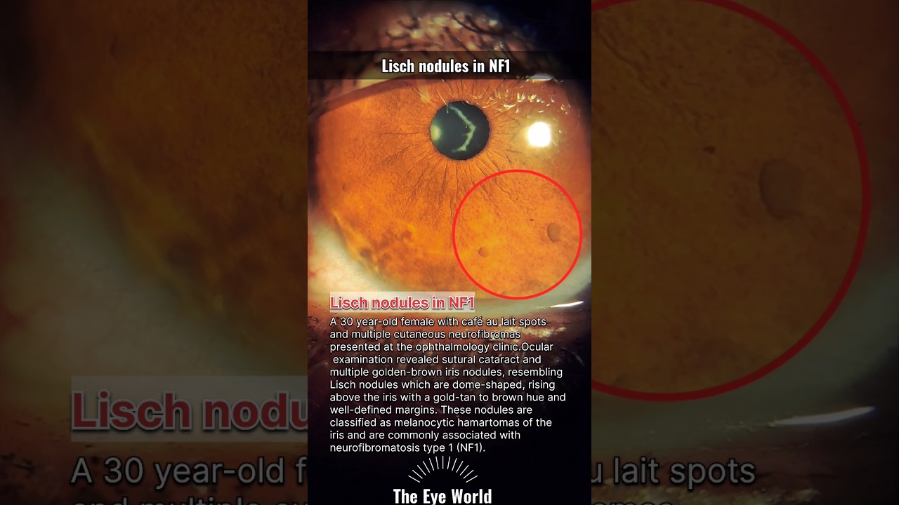 Lisch nodules in neurofibromatosis type 1 #eyes #ophthalmology #iris #the_eye_world