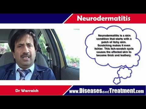 Neurodermatitis : Causes, Diagnosis, Symptoms, Treatment, Prognosis
