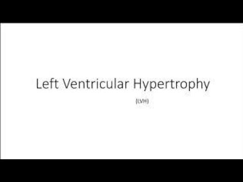 LVH in EKG | Left Ventricular Hypertrophy in ECG | Cornell Criteria | ECG Series |Mightymedicoz