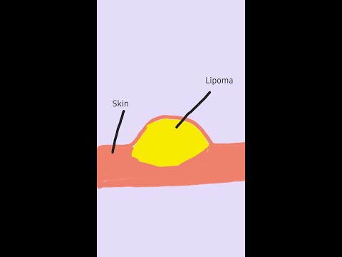 Positive Points in favour of Lipoma #shorts 8