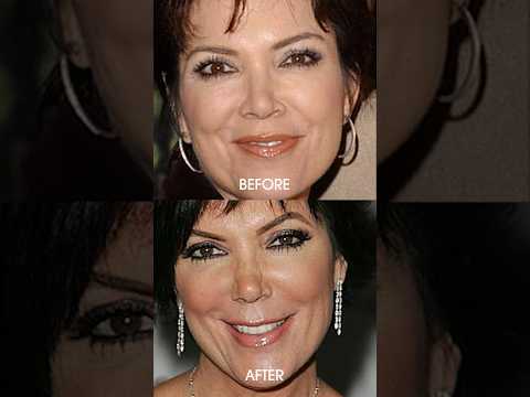 Kris Jenner… Board-Certified Plastic Surgeons Want to Fix Your Nose! 🤥🫠