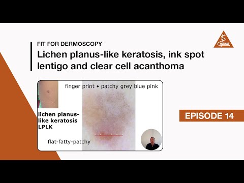 Fit for Dermoscopy Episode 14 - Lichen planus-like keratosis, ink spot lentigo &clear cell acanthoma