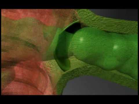 Sphincter of Oddi Dysfunction