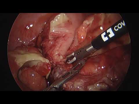 Laparoscopic Appendectomy for Perforated Ruptured Appendicitis, Tips and Tricks